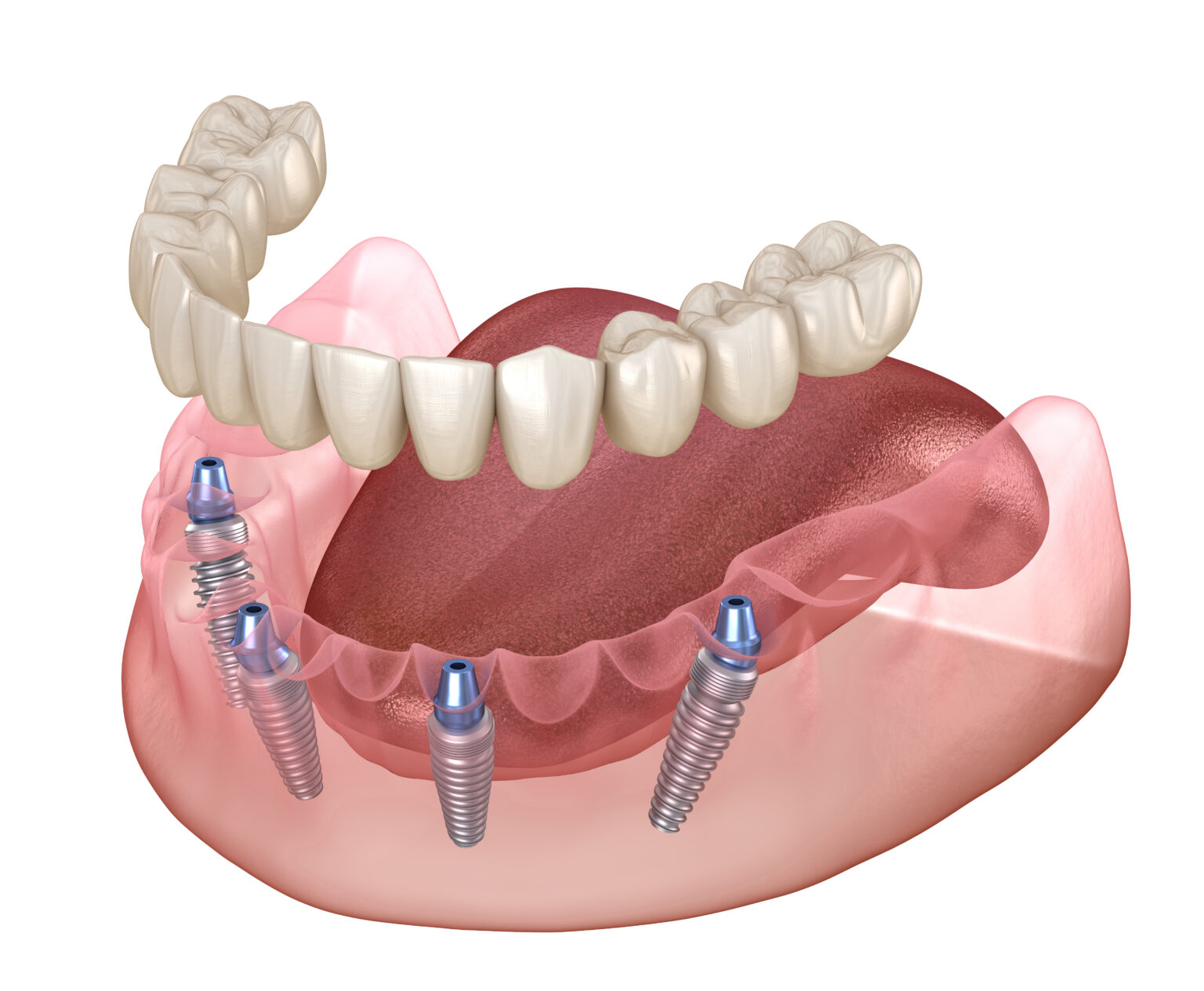 Full Arch Implants / Implant-Retained Dentures - Southeastern Dental Care