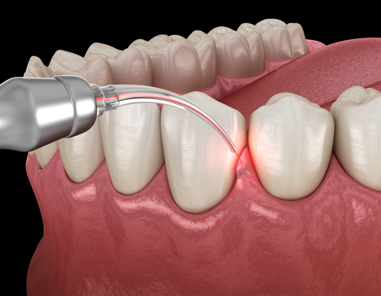 LANAP Laser Gum Treatment for Advanced Periodontal Care